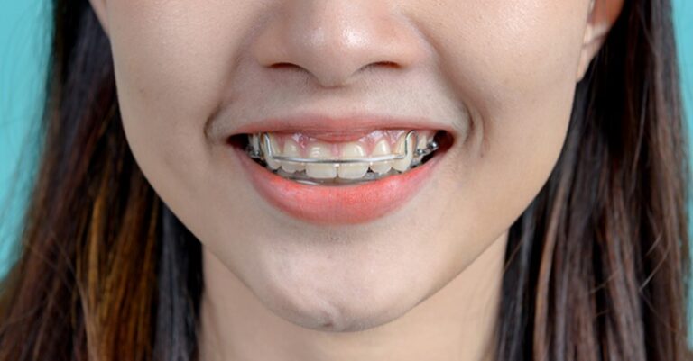 RETENEDORES DENTALES DESPUÉS DE LA ORTODONCIA: QUÉ CLASES HAY Y CÓMO ...