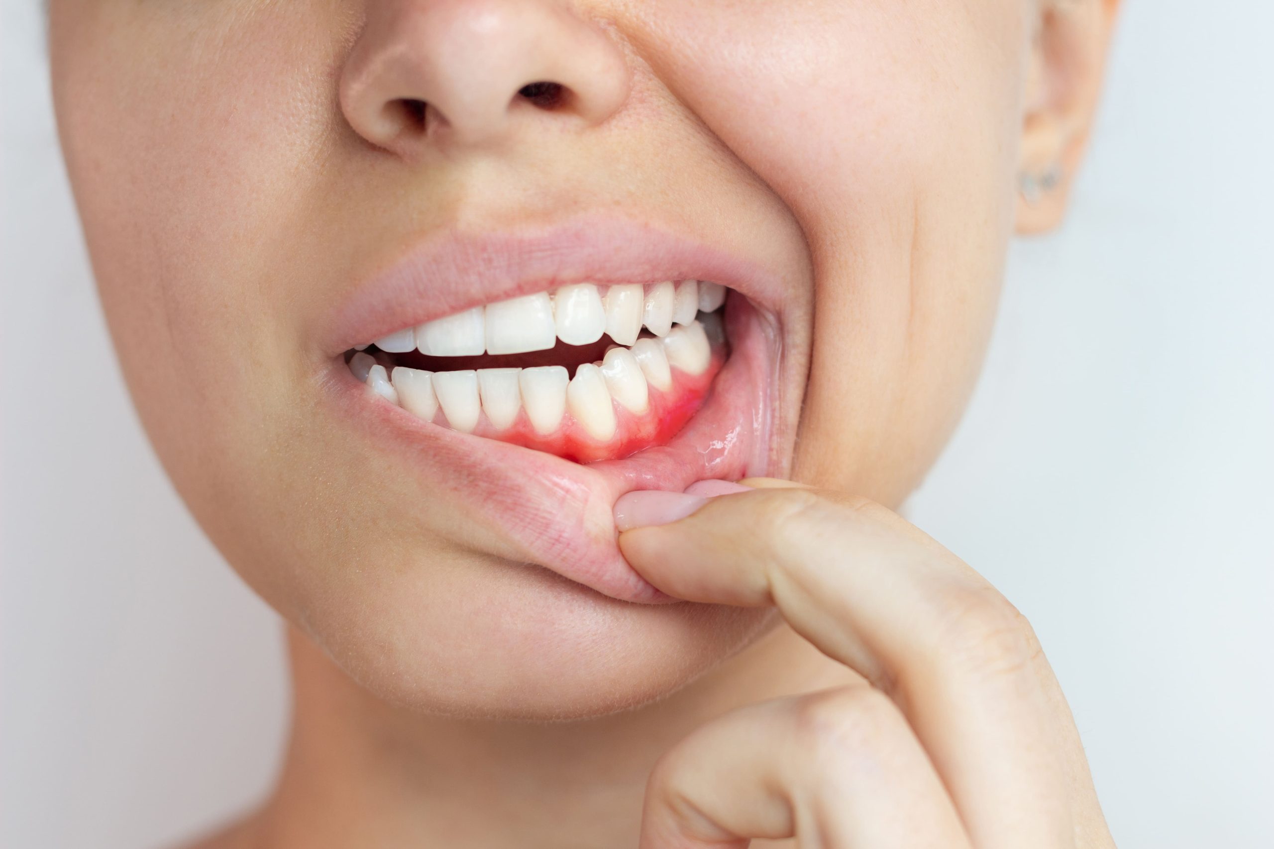 La boca como indicador de inflamación crónica - Dental Mares